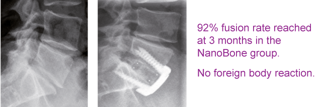 NanoBone® - Biocomposites